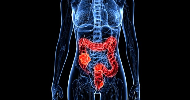Colon Cancer Rising In People Under 50 CBS News