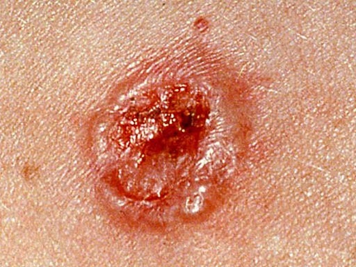 Skin cancer or mole? How to tell
