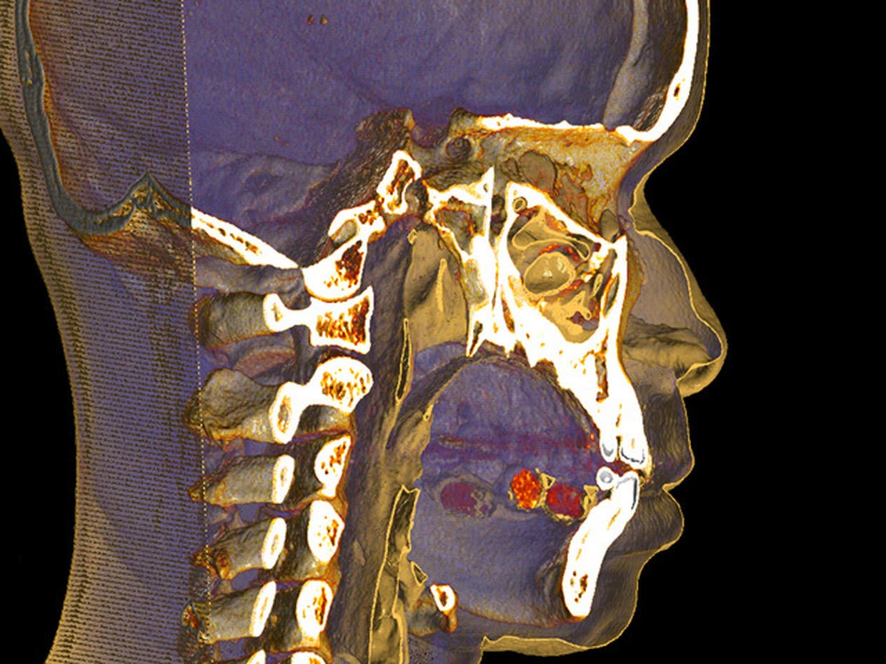 Busted! Drug mules caught on CT scans - Photo 1 - CBS News