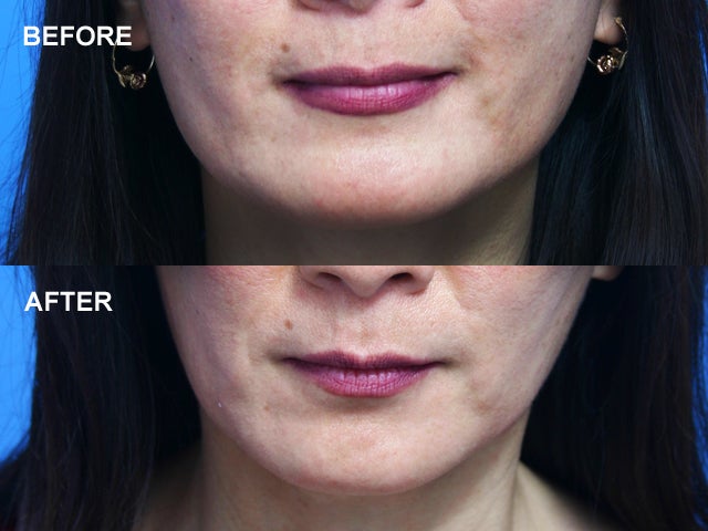 Heart Shaped Lips Plastic Surgery | Lipstutorial.org
