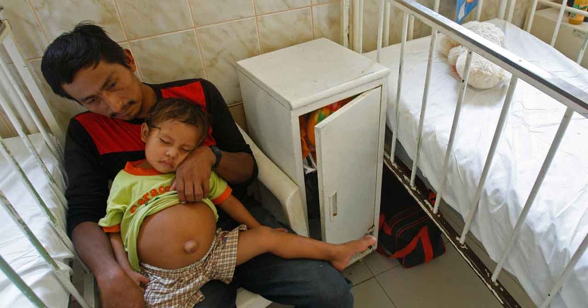 Peru doctors to remove "parasitic twin" from boy - CBS News