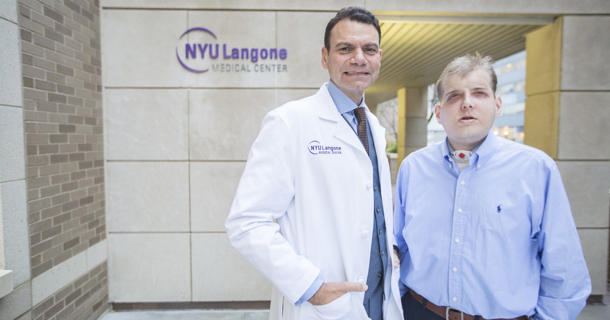 Mississippi firefighter Patrick Hardison gets most extensive face ...