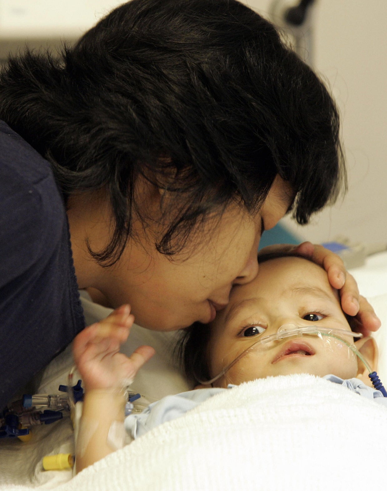 Conjoined twins (WARNING: GRAPHIC IMAGES)