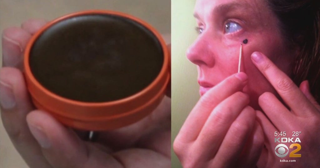 Remedy Or Ruse: Doctors Issue Warning About Use Of 'Black Salve' As ...