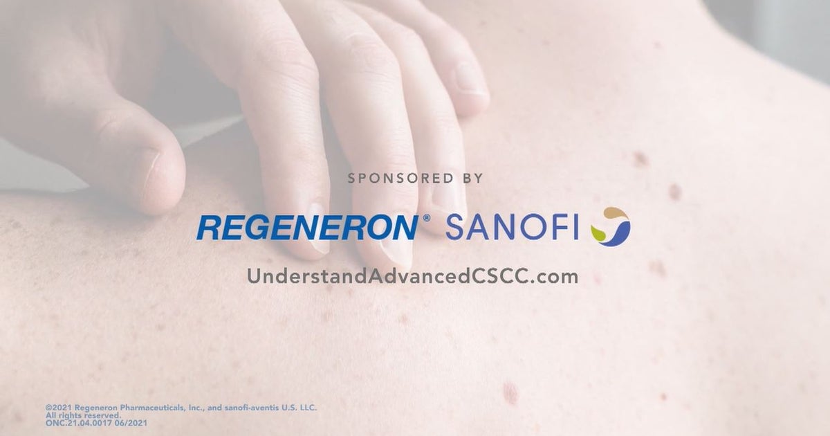 Understanding Two Types Of Advanced Non-melanoma Skin Cancer - CBS Chicago